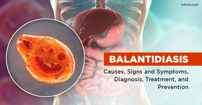 What Is Balantidiasis?