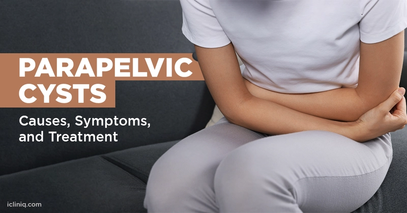 iCliniq Medical Conditions - Parapelvic Cysts