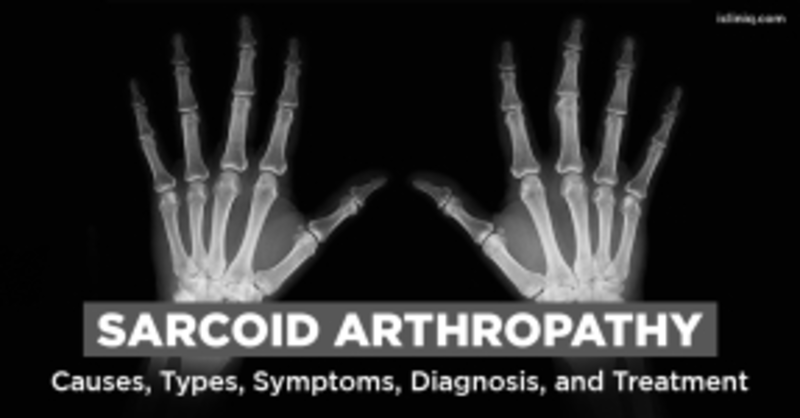 Health Articles in Sarcoid Arthropathy