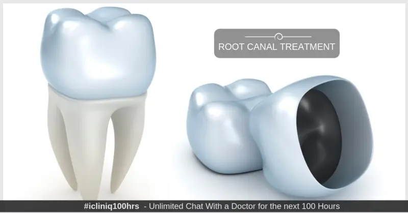Is a crown necessary for me after a root canal treatment?