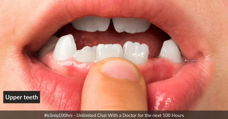 When talking or smiling, my upper teeth is barely visible. What could ...