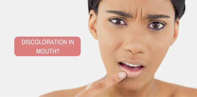 What causes discoloration in the mouth?