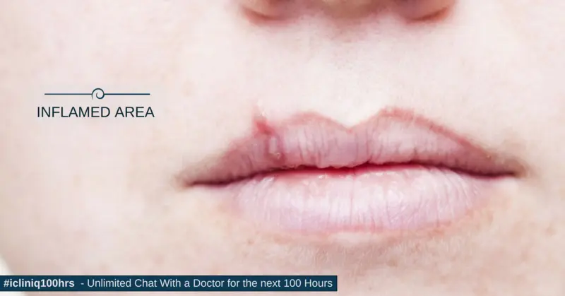 I have a red inflamed area on my upper lip. Why?